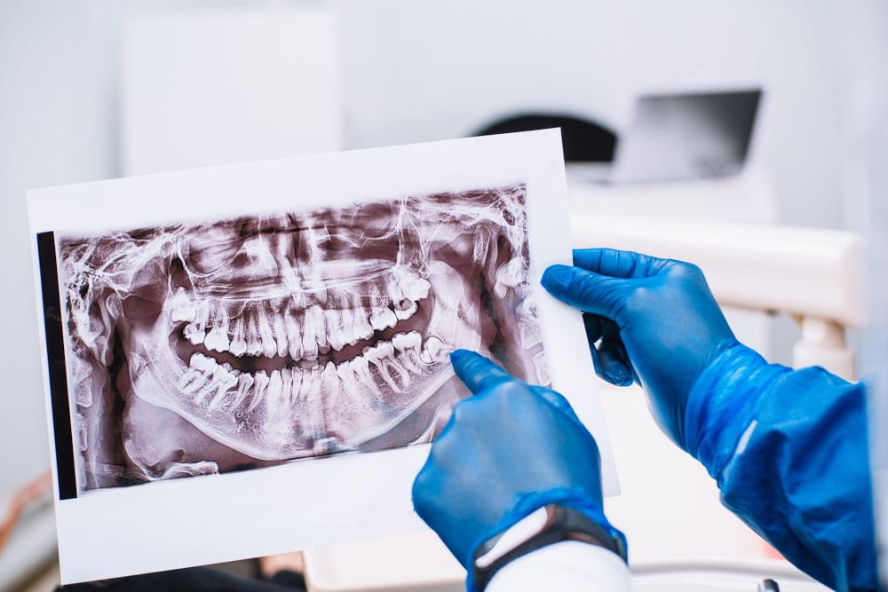 Should I Have All My Wisdom Teeth Removed? - Maple Dental Health Blog