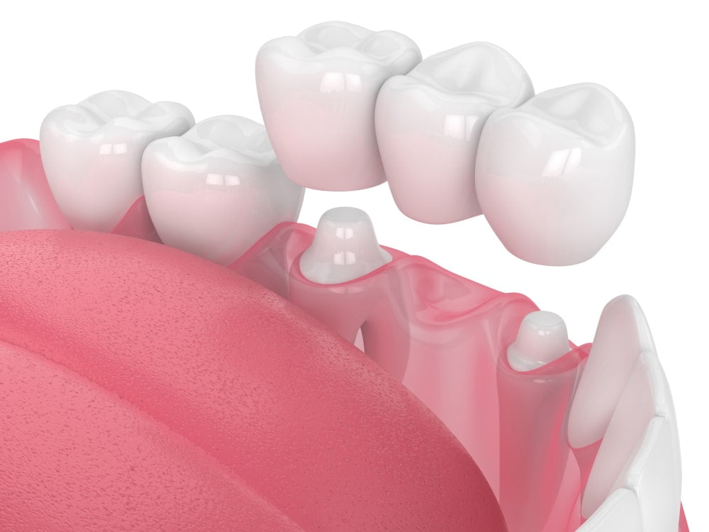 Tooth Bridges: Everything You Need to Know - Maple Dental Health Blog
